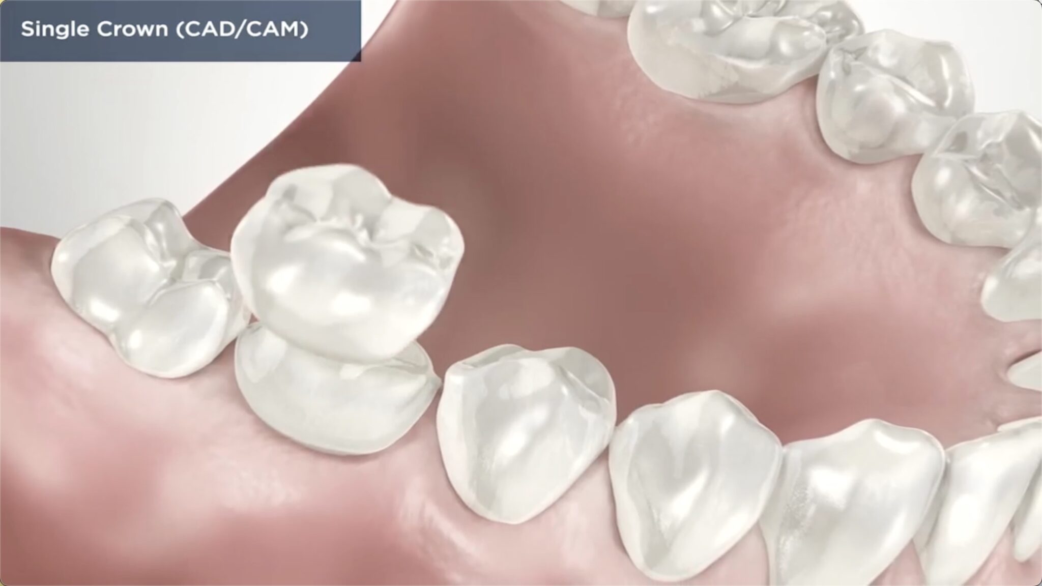 Dental Crowns Vancouver WA | Same Day Crowns